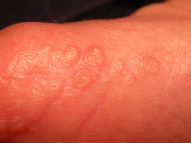 Acrokeratosis verruciformis | PPT