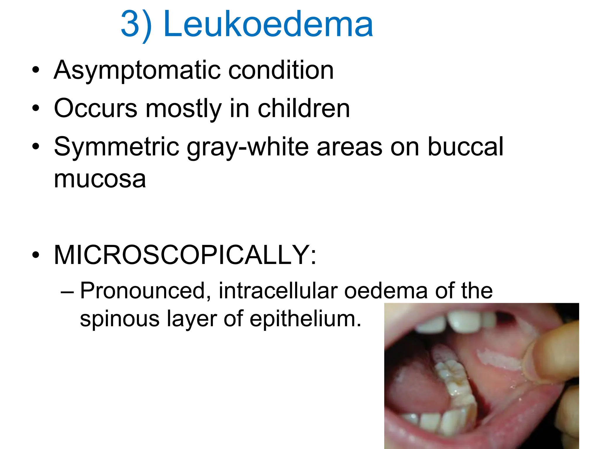 Commonest diseases and tumors of ORAL CAVITY.ppt