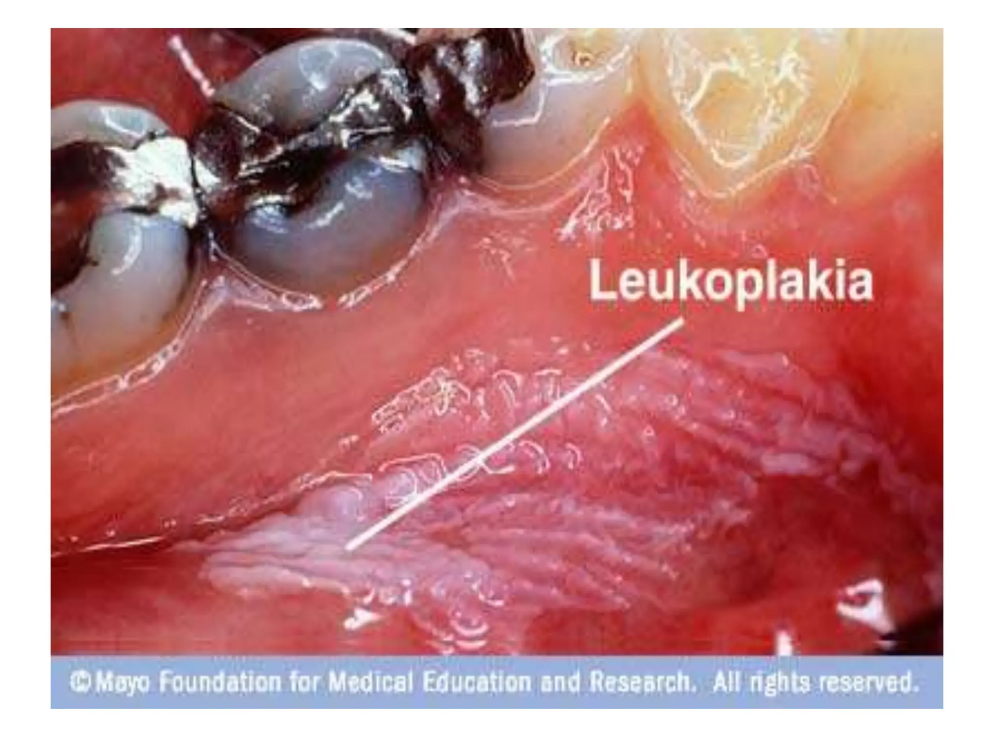 Commonest Diseases And Tumors Of Oral Cavityppt