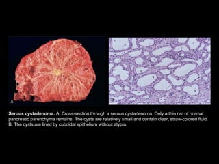 Lesions quísticas páncreas | PPTX