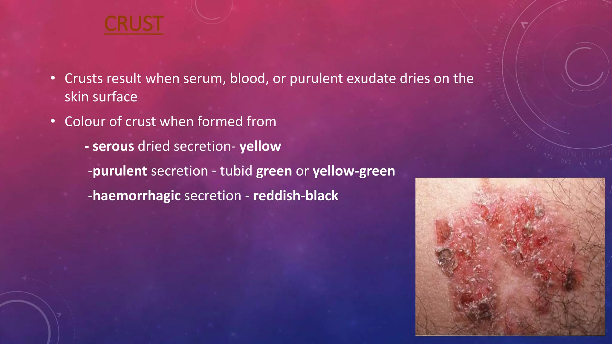 Lesion of skin | PPTX