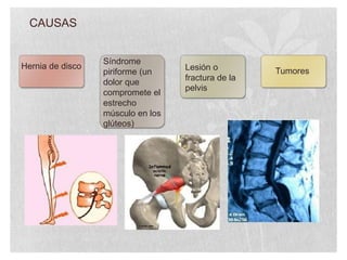 Lesion y paralisis de plexo lumbar | PPTX
