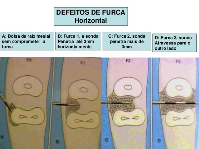Lesão de furca