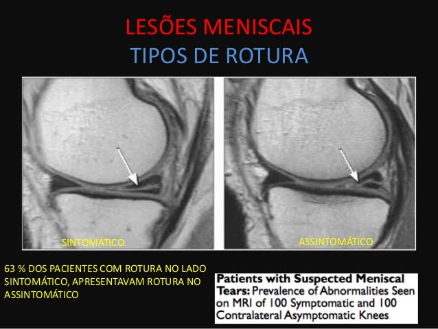 Lesoes meniscais cj1