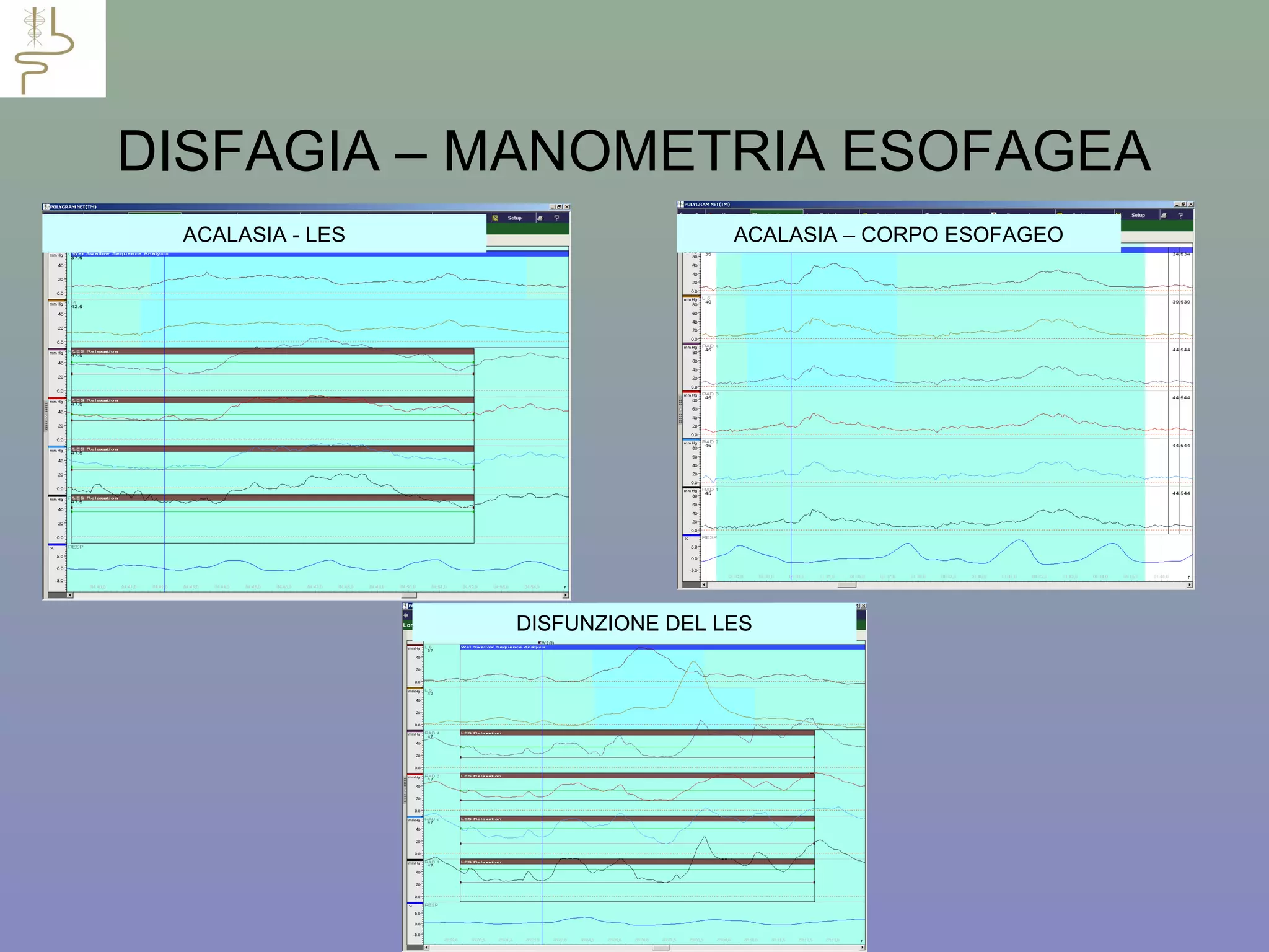 Frazzoni M. L'Esofago Minore: i Disturbi Motori e l'Esofagite ...