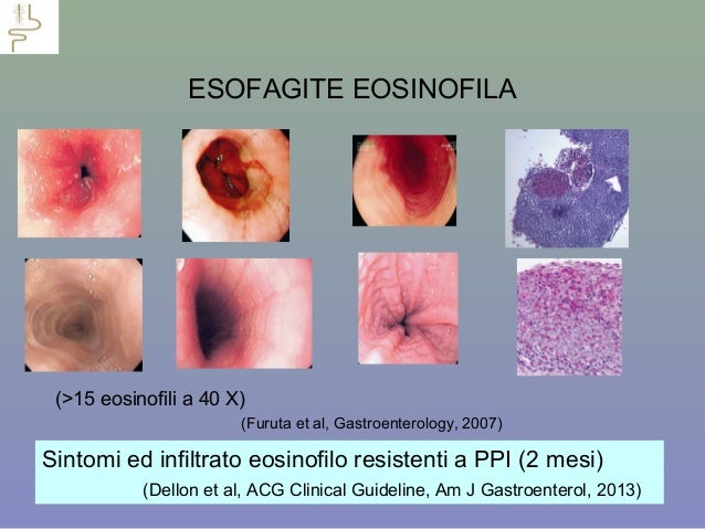 Frazzoni M. L'Esofago Minore: i Disturbi Motori e l'Esofagite Eosinof…
