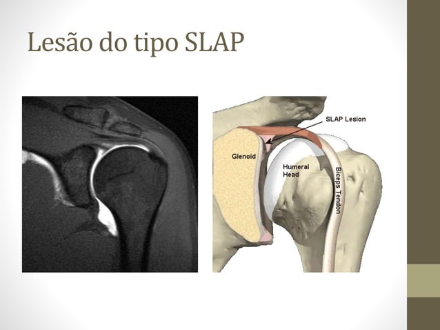 Lesão labral do tipo slap | PPT