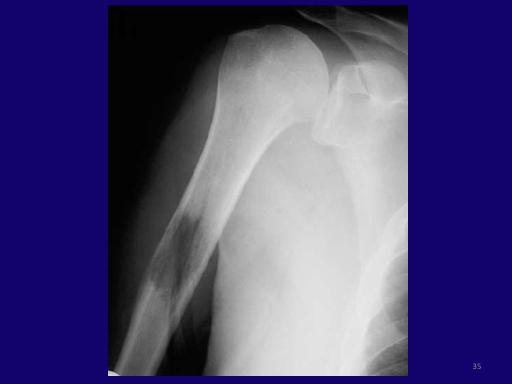 Lesão litica sessão de raciocinio clínico