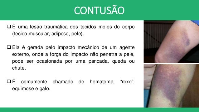 Lesão muscular