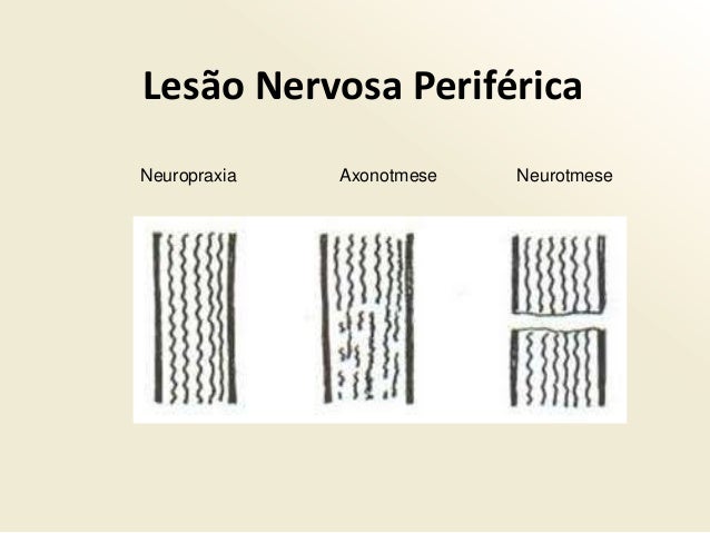 Lesão nervosa periferica