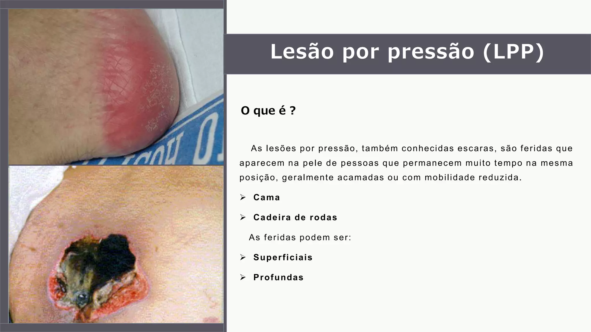 LESÃO POR PRESSÃO E CURATIVOS.pptx