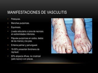 Lupus Eritematoso Sistemico. | PPTX