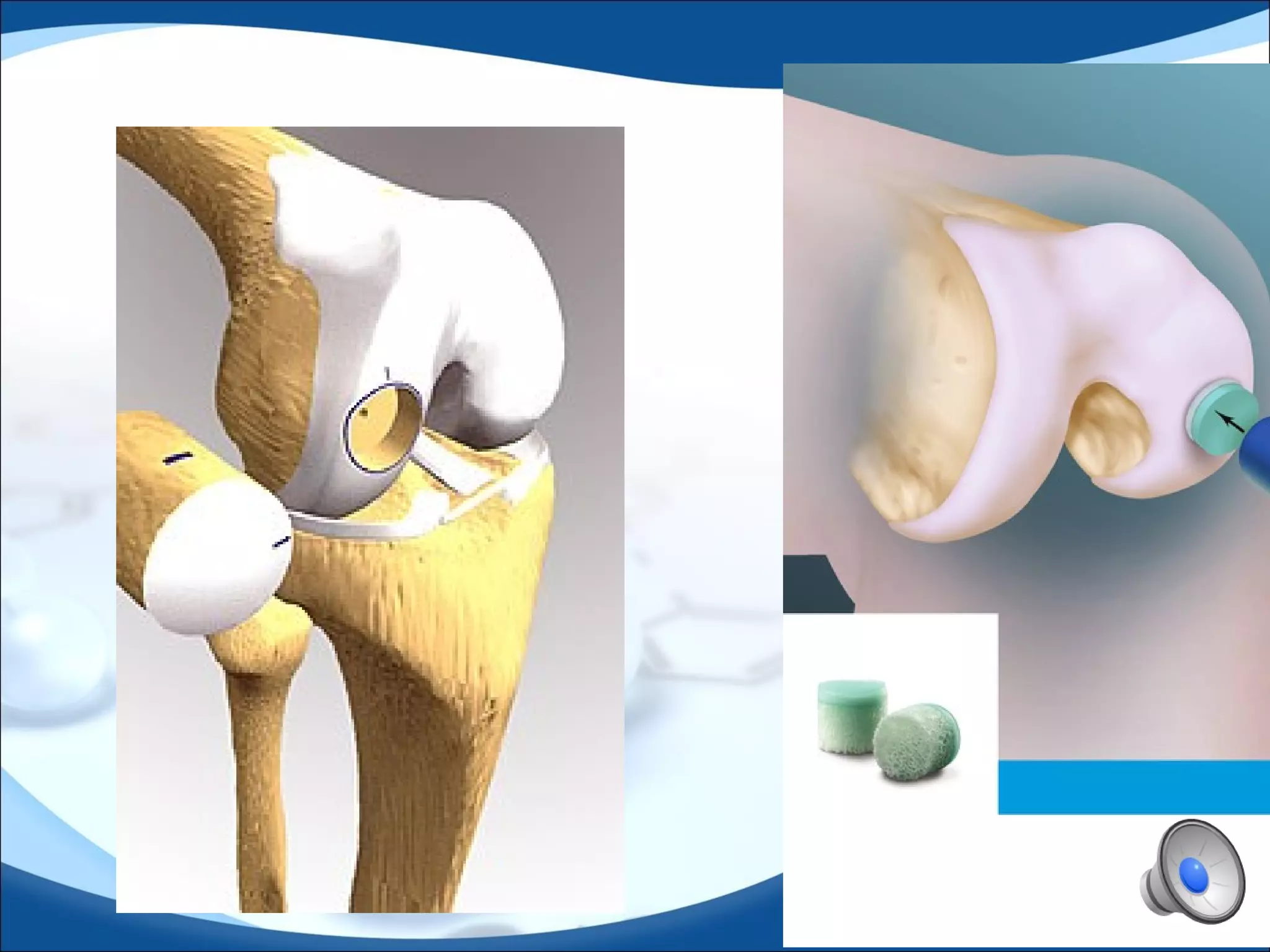 LESS current treatment of cartilage defects | PPT