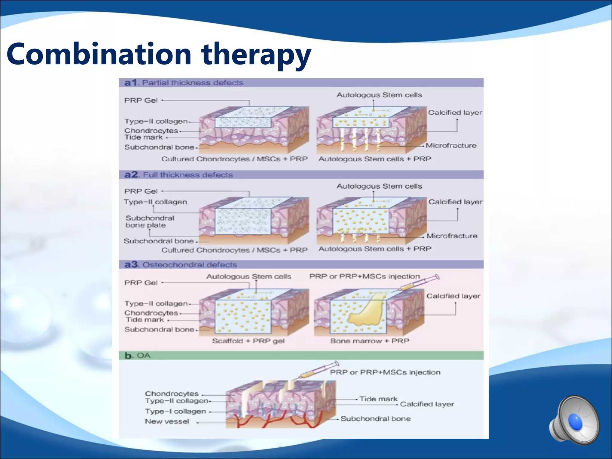 LESS current treatment of cartilage defects | PPT