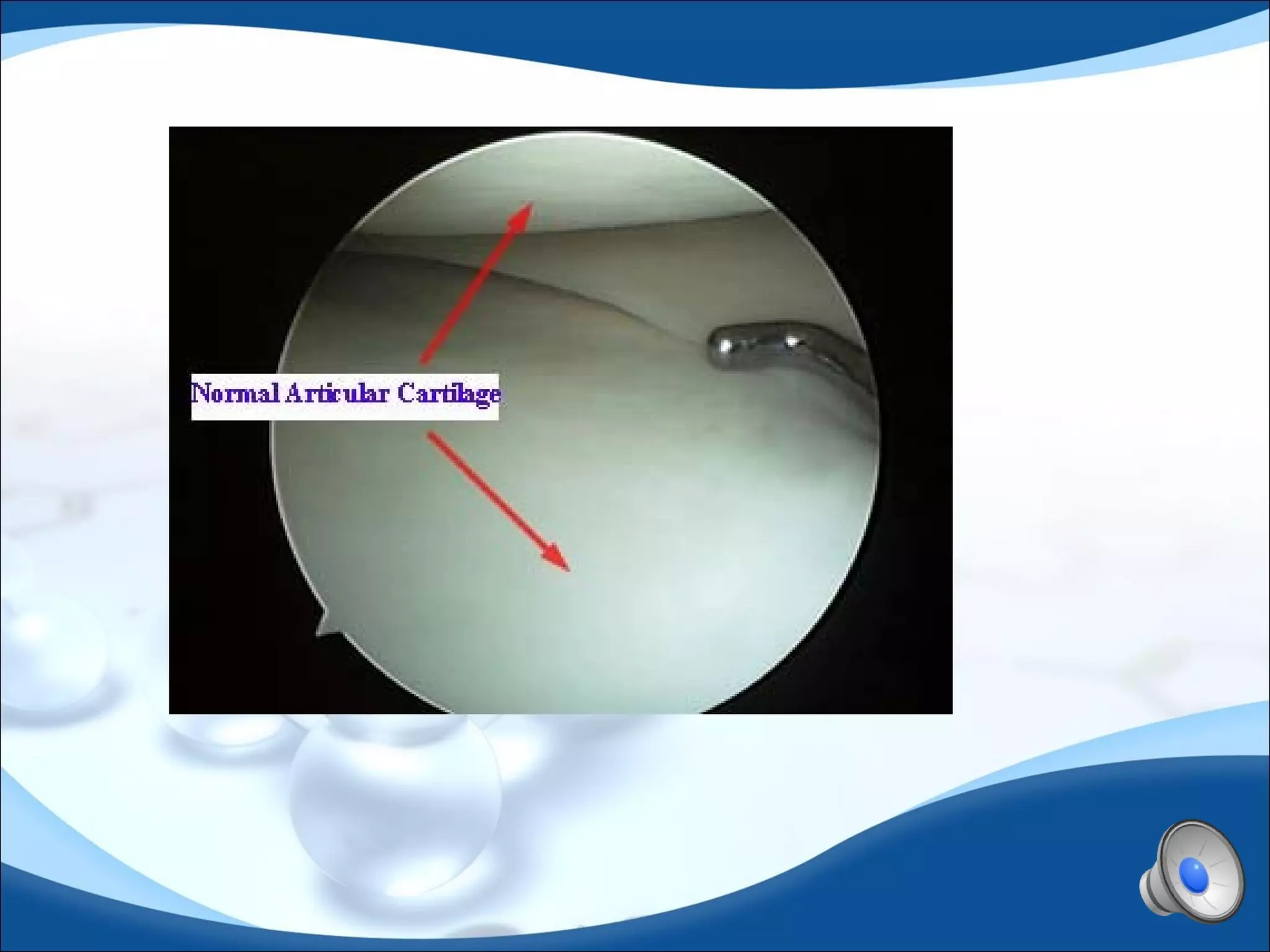 LESS current treatment of cartilage defects | PPT