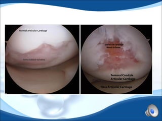 LESS current treatment of cartilage defects | PPT