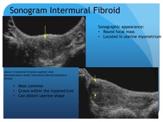“Understanding Uterine Fibriods &Their Sonographic Appearances” | PPTX