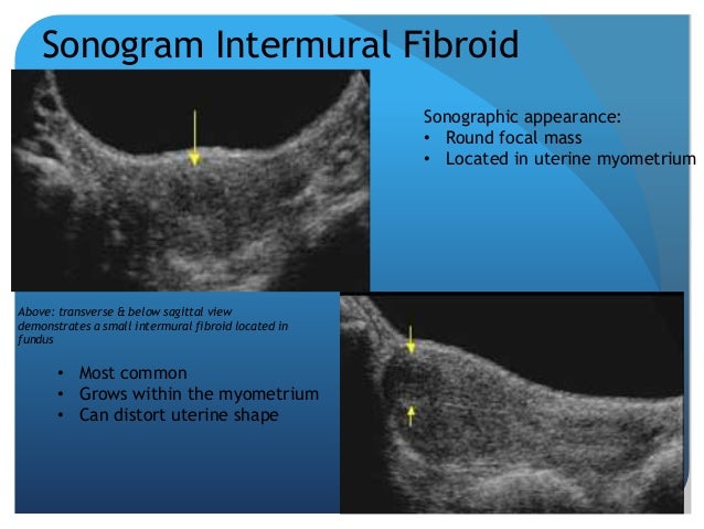 “understanding Uterine Fibriods Andtheir Sonographic Appearances”