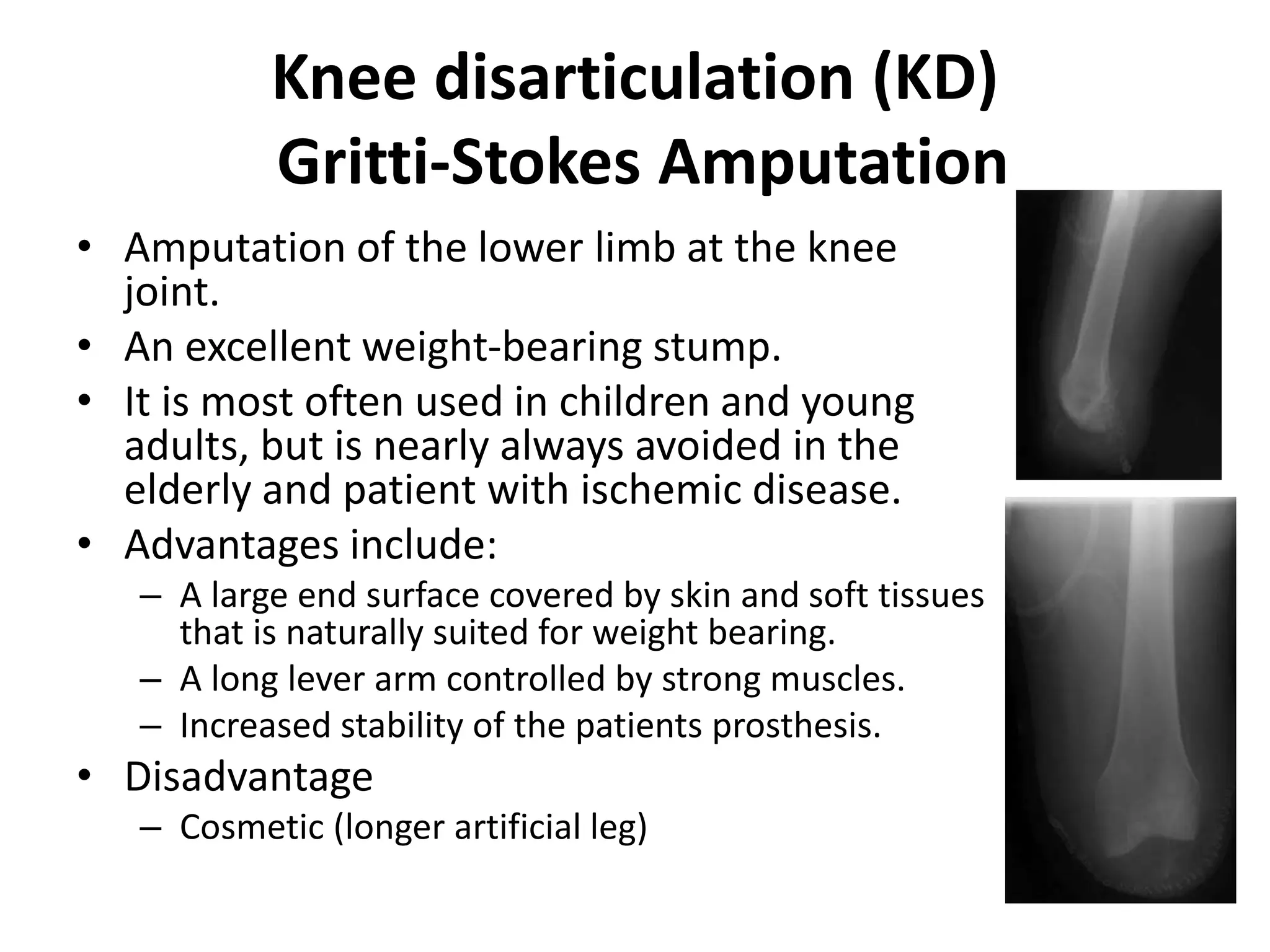 Lesson 3 Levels of Amputation.ppt