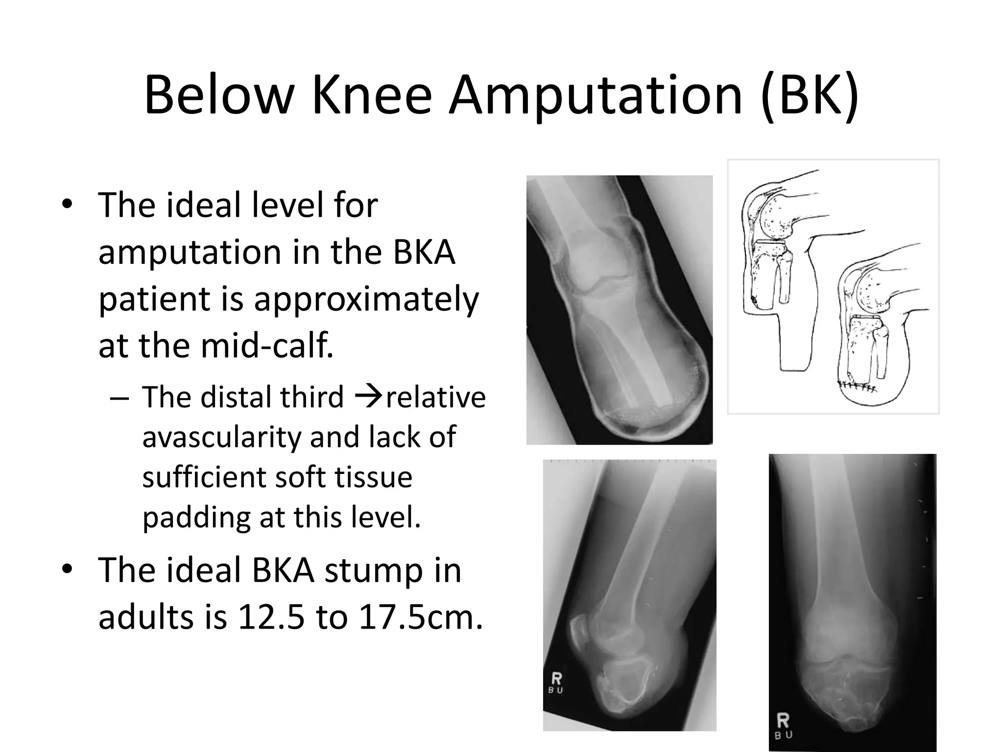 Lesson 3 Levels of Amputation.ppt