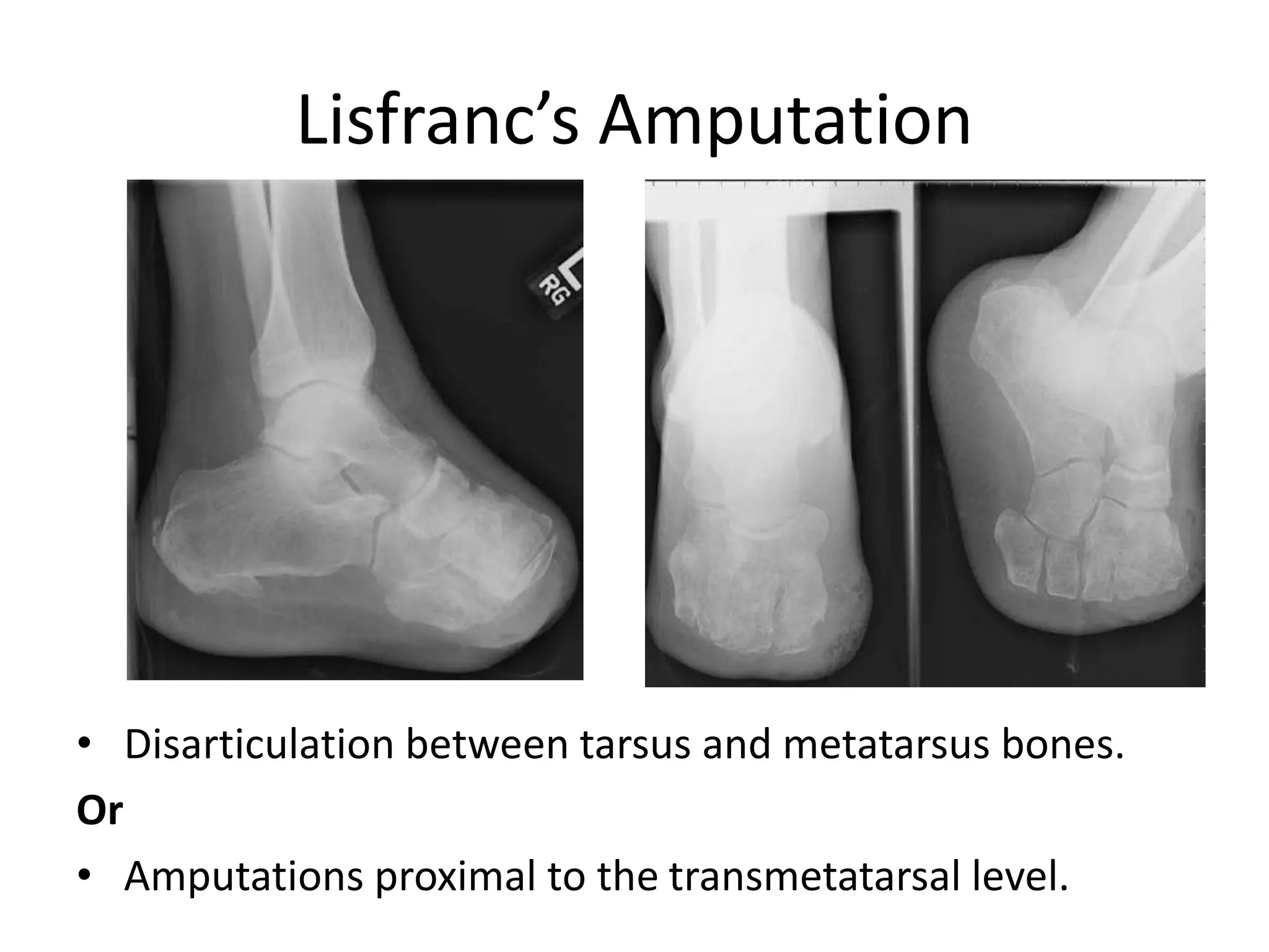 Lesson 3 Levels of Amputation.ppt