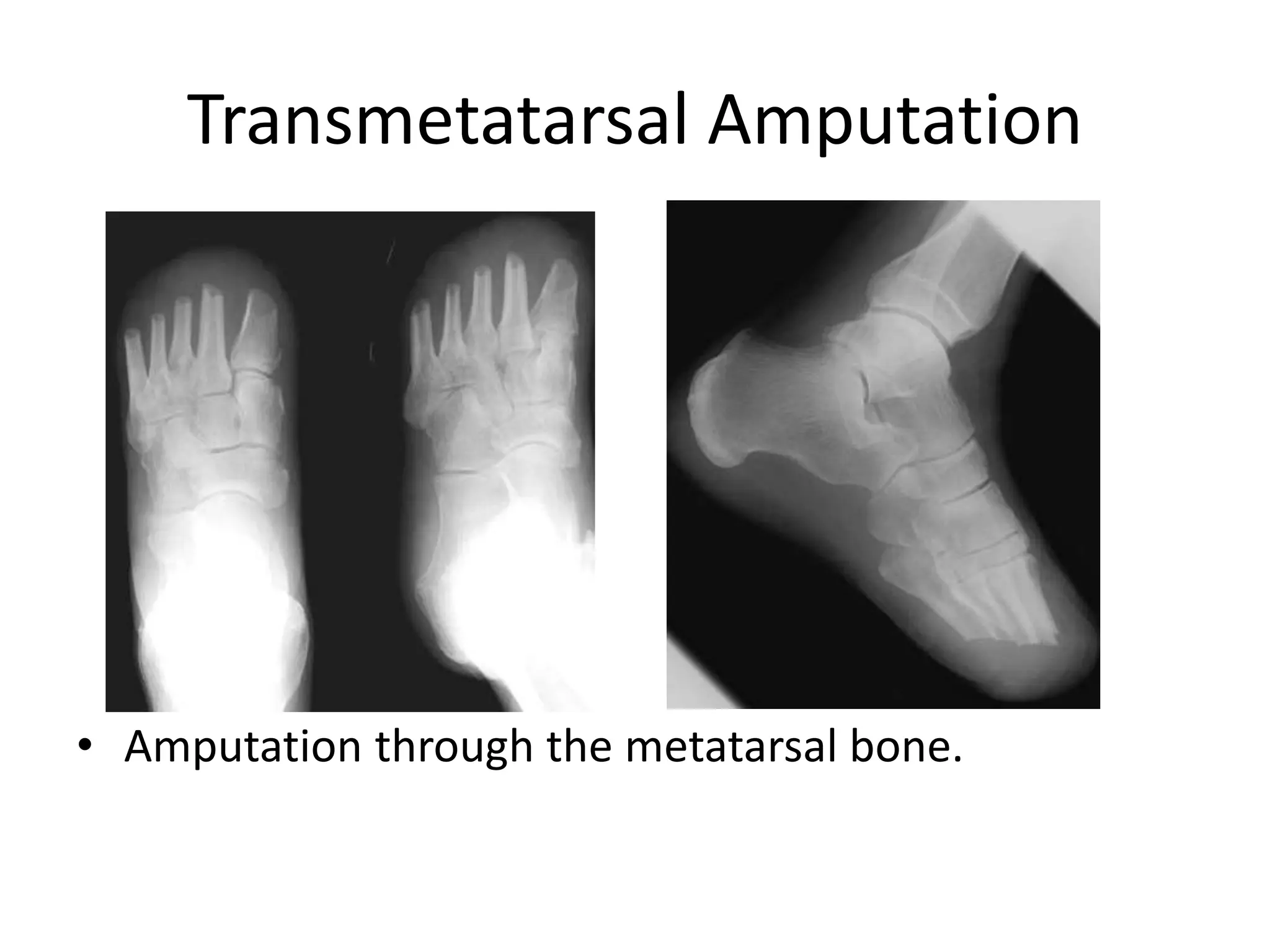 Lesson 3 Levels of Amputation.ppt