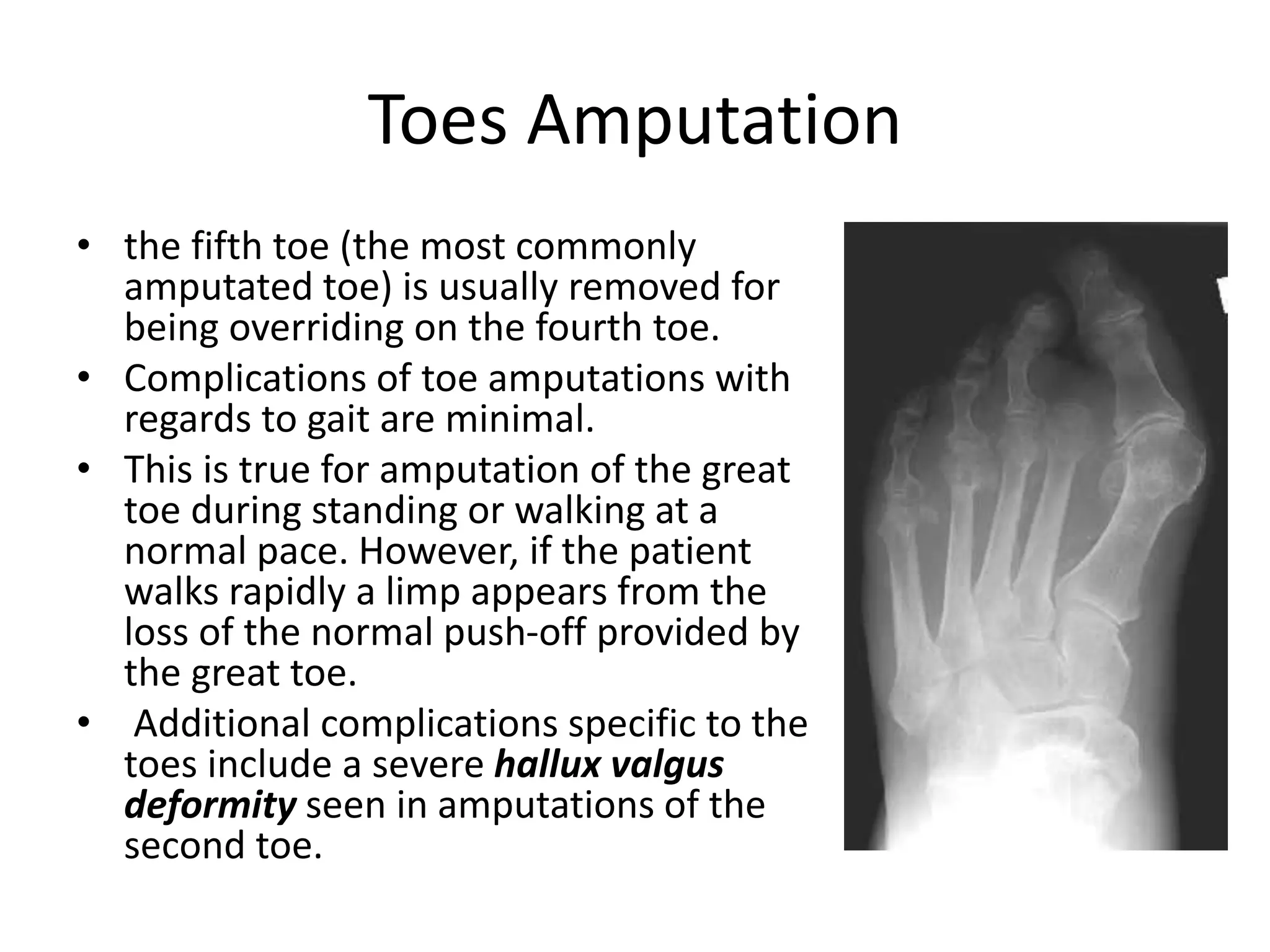 Lesson 3 Levels of Amputation.ppt