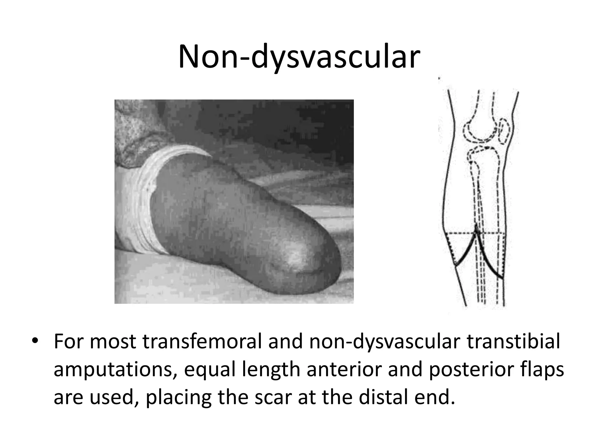 Lesson 3 Levels of Amputation.ppt