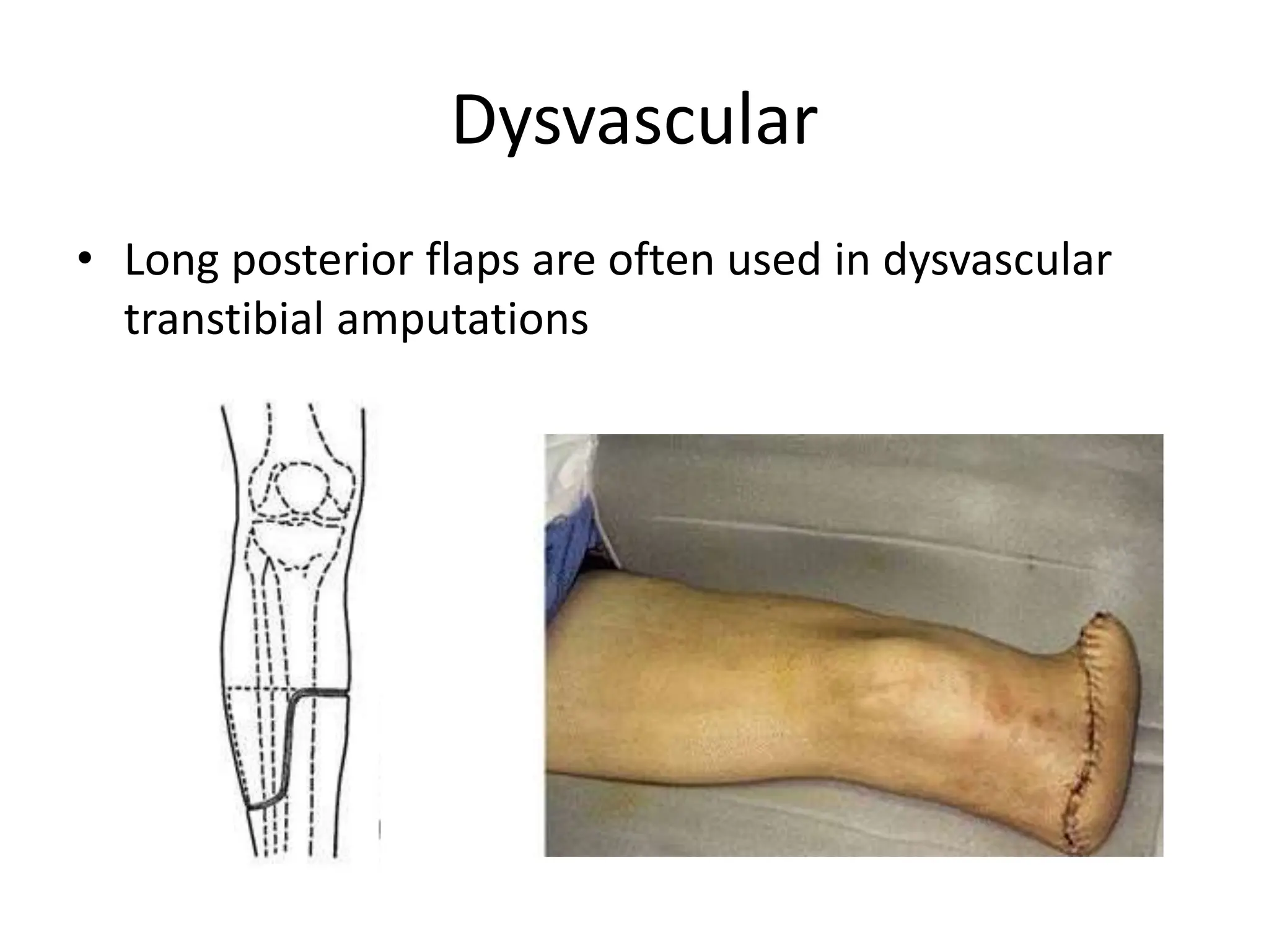 Lesson 3 Levels of Amputation.ppt