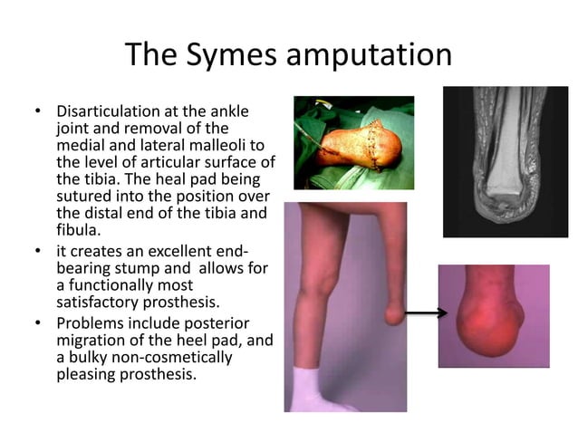 Lesson 3 Levels of Amputation.ppt | Death, Injury, or Military Conflict | Sensitive Topics