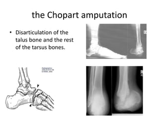 Lesson 3 Levels of Amputation.ppt