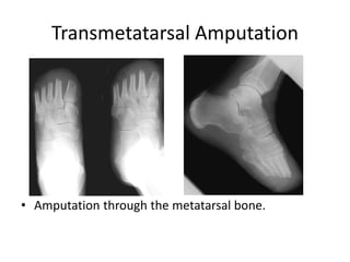 Lesson 3 Levels of Amputation.ppt