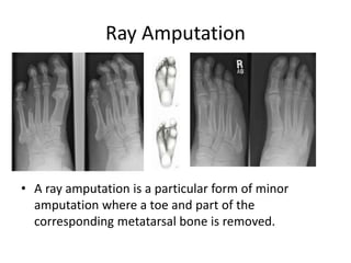 Lesson 3 Levels of Amputation.ppt | Death, Injury, or Military Conflict ...