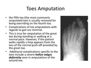 Lesson 3 Levels of Amputation.ppt