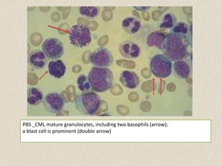 Lesson 4 chronic myeloid leukemia - CML.ppt