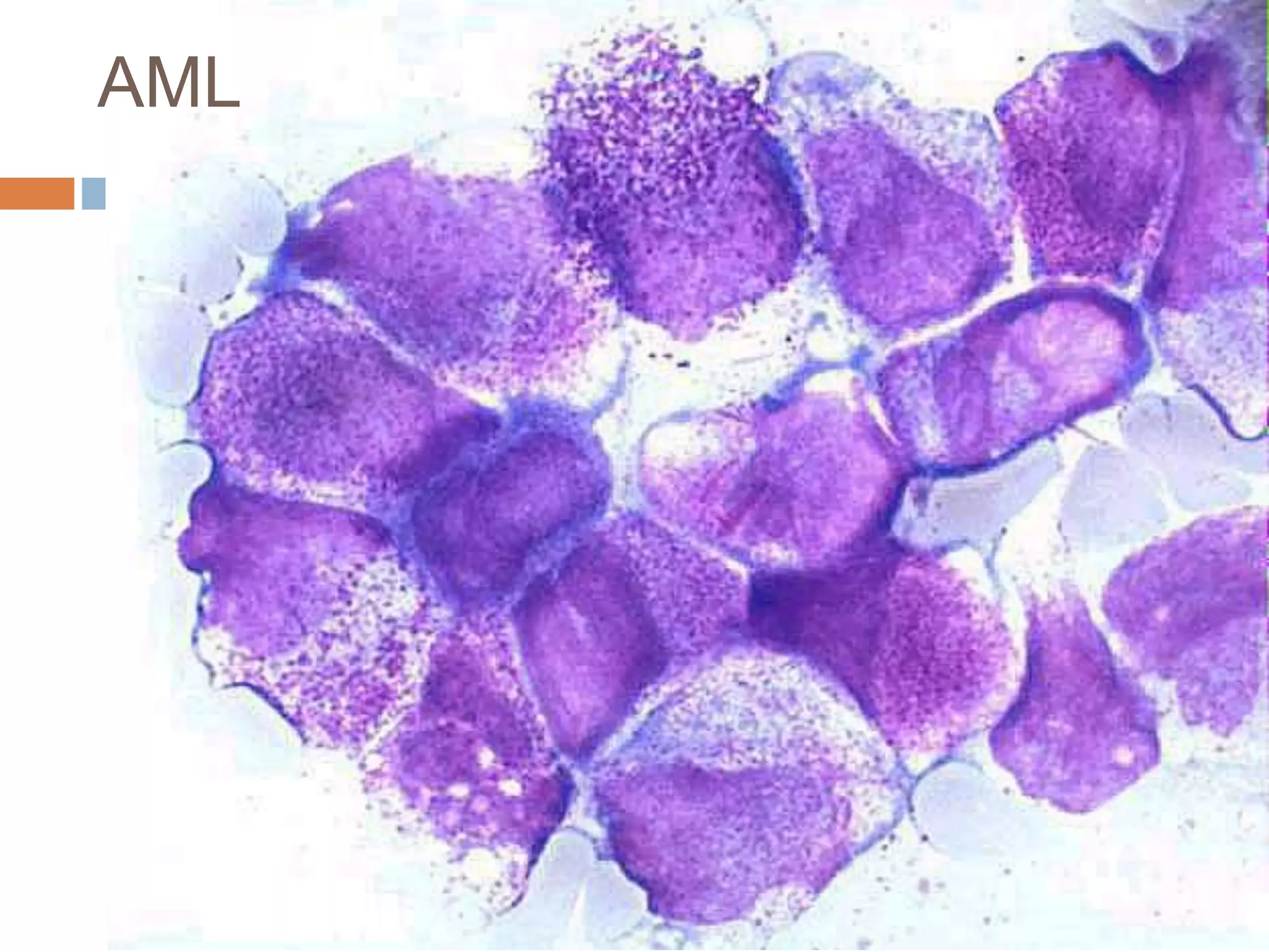 LESSON 4 leukaemia.ppt
