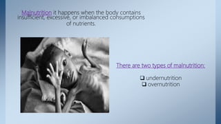 Lesson 4 types of malnutrition | PPT