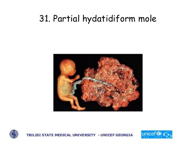hemorrhagic complication in first trimester