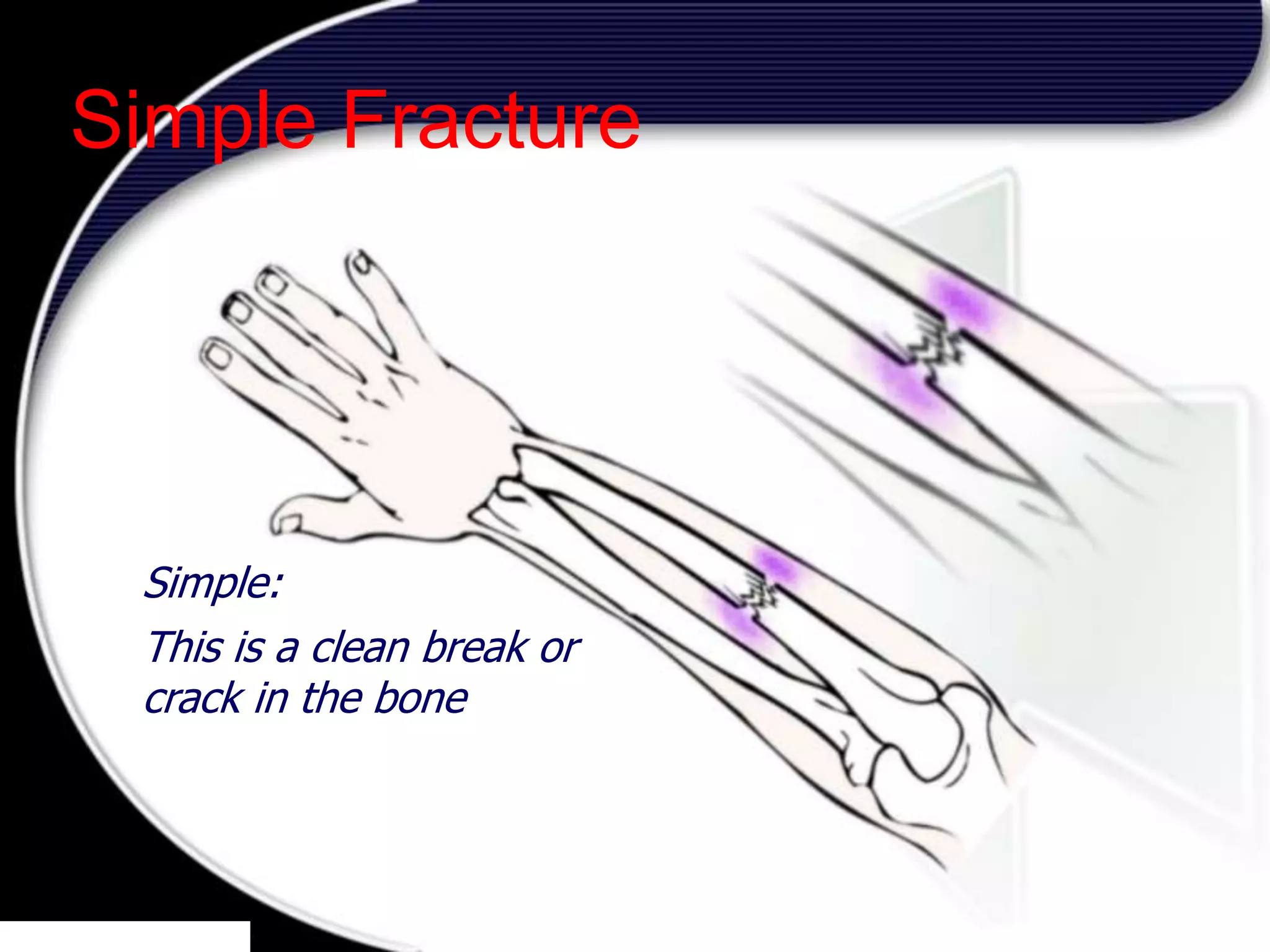 First Aid in fractures | PPTX