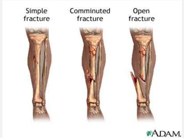 First Aid in fractures