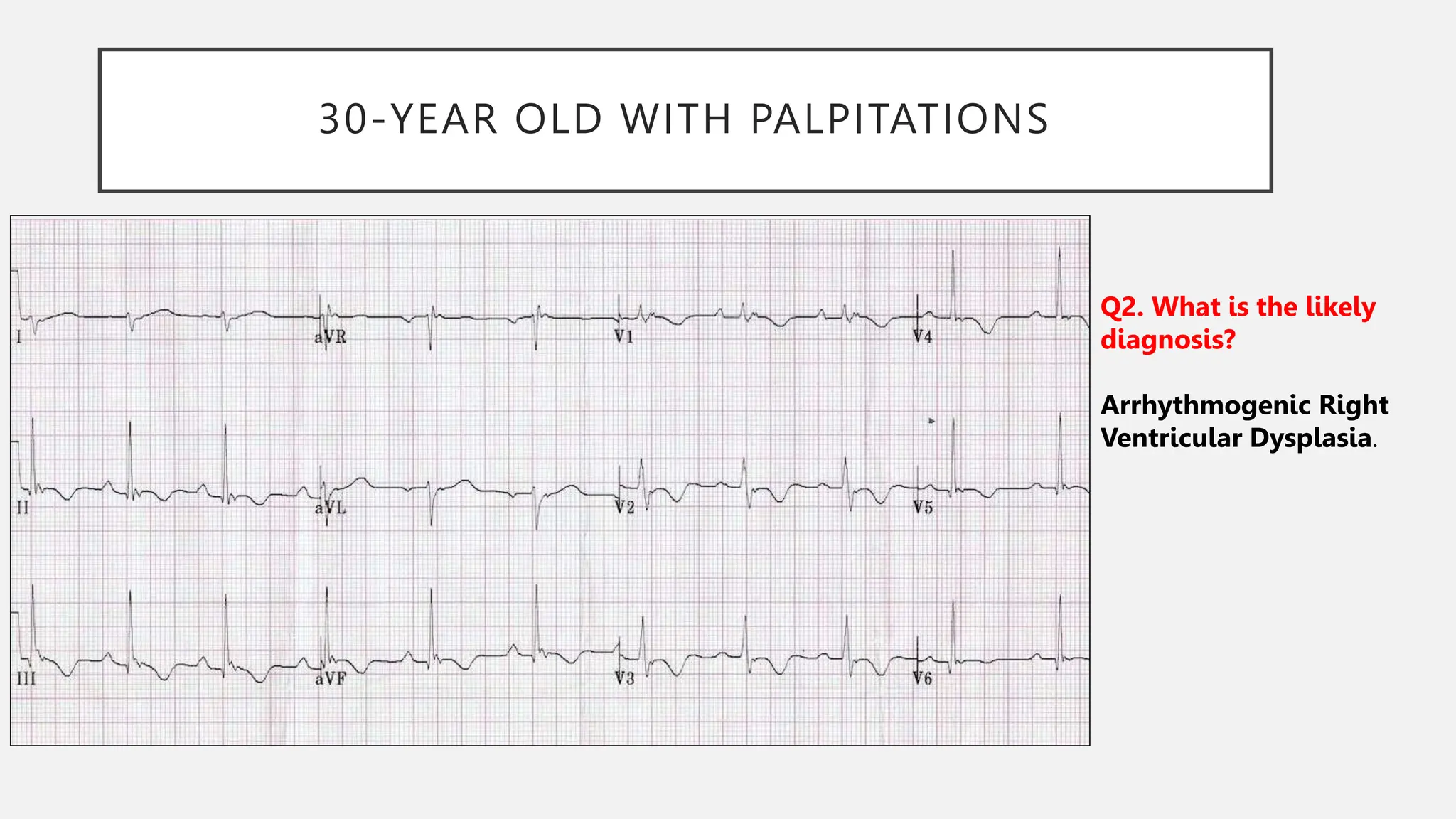 Lethal ECG pattern reading and diagnosis.pptx