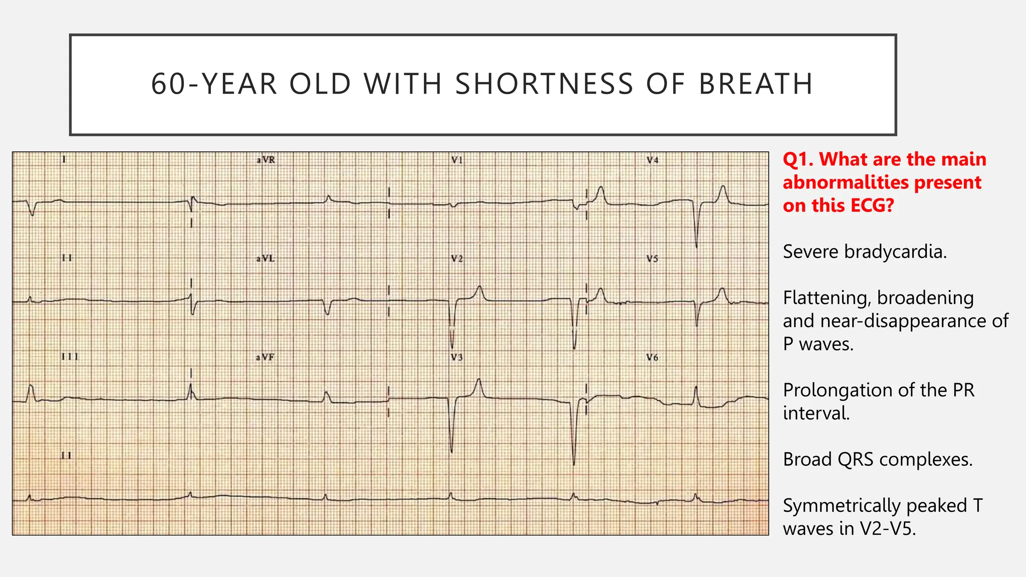 Lethal ECG pattern reading and diagnosis.pptx