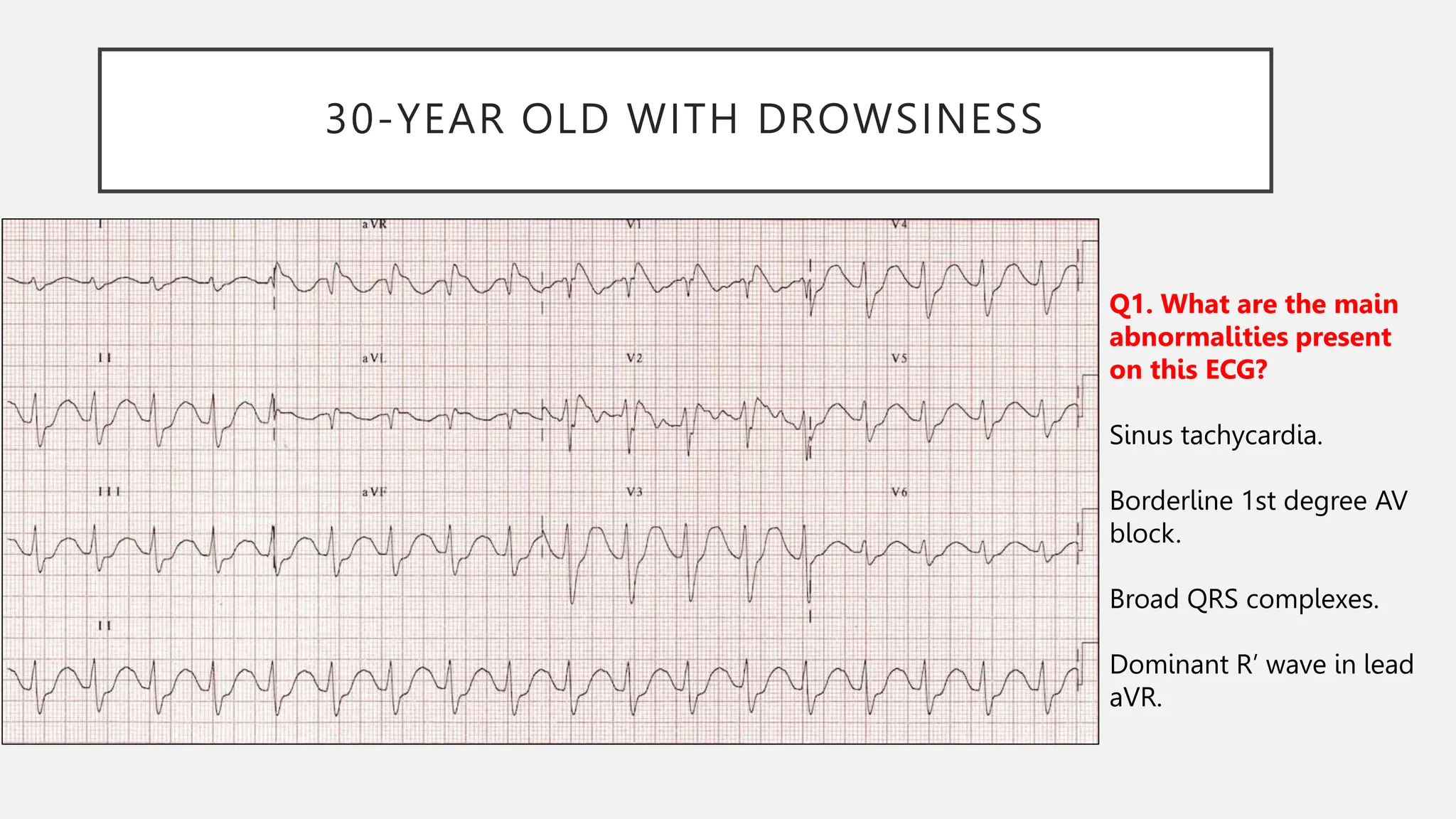 Lethal ECG pattern reading and diagnosis.pptx