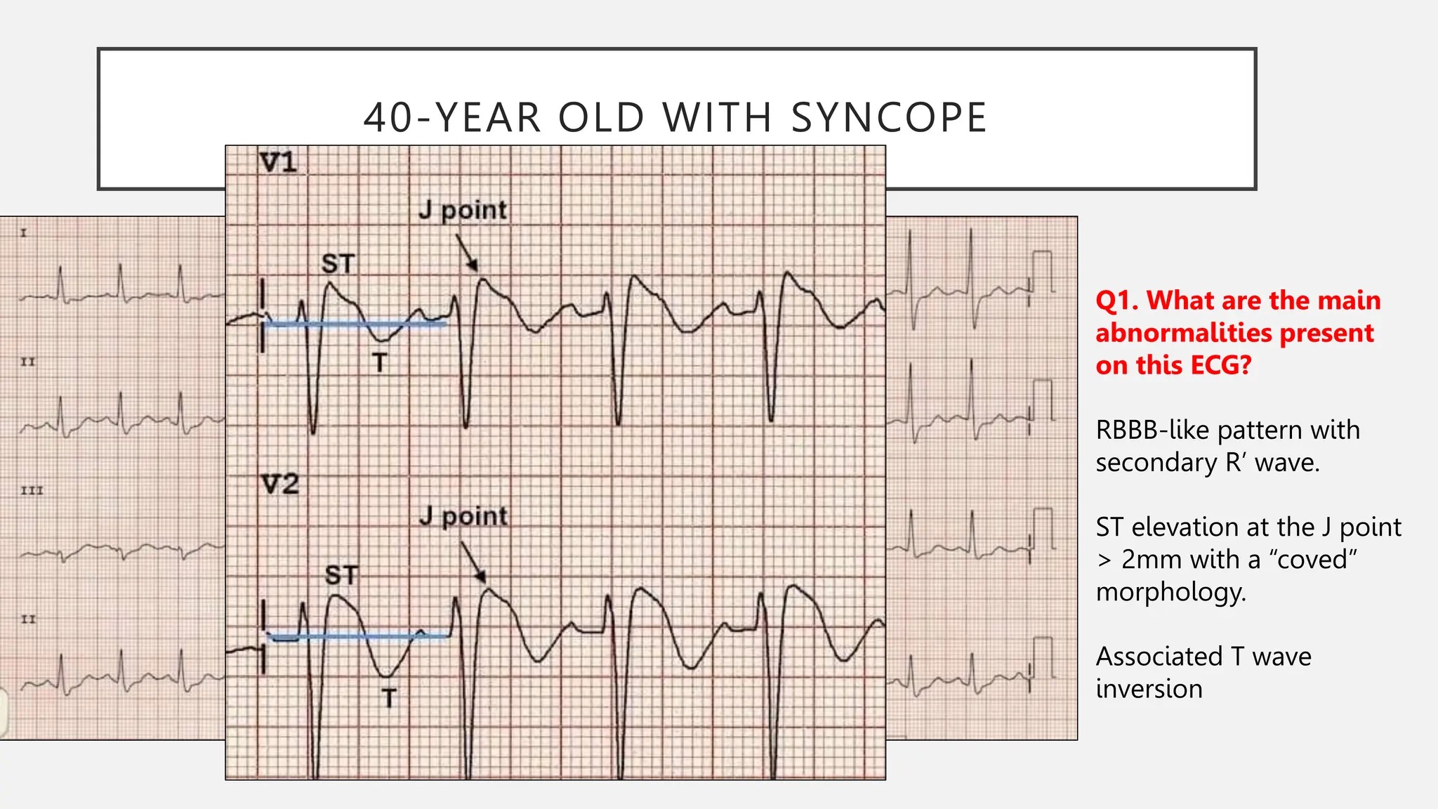 Lethal ECG pattern reading and diagnosis.pptx