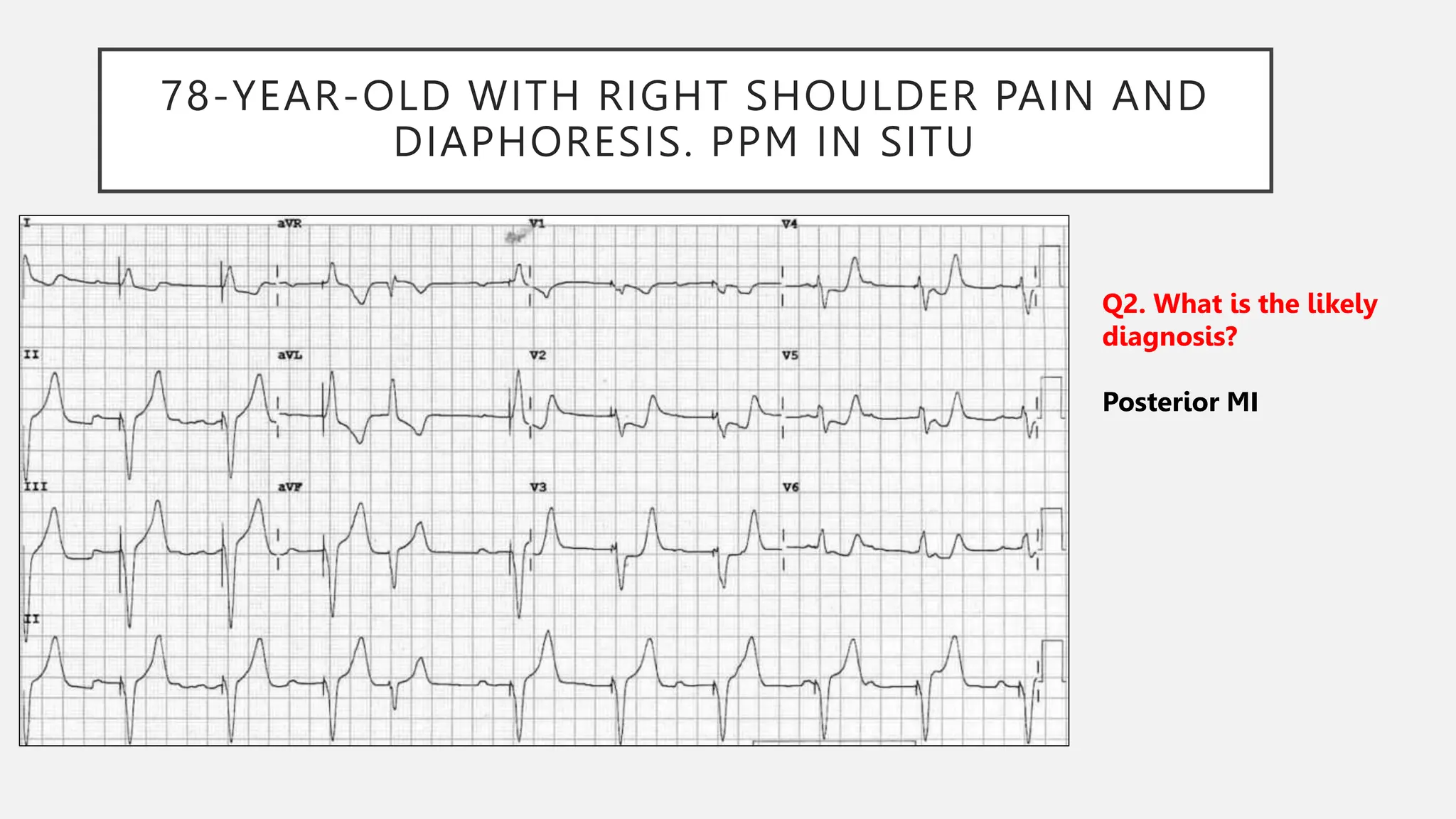 Lethal ECG pattern reading and diagnosis.pptx