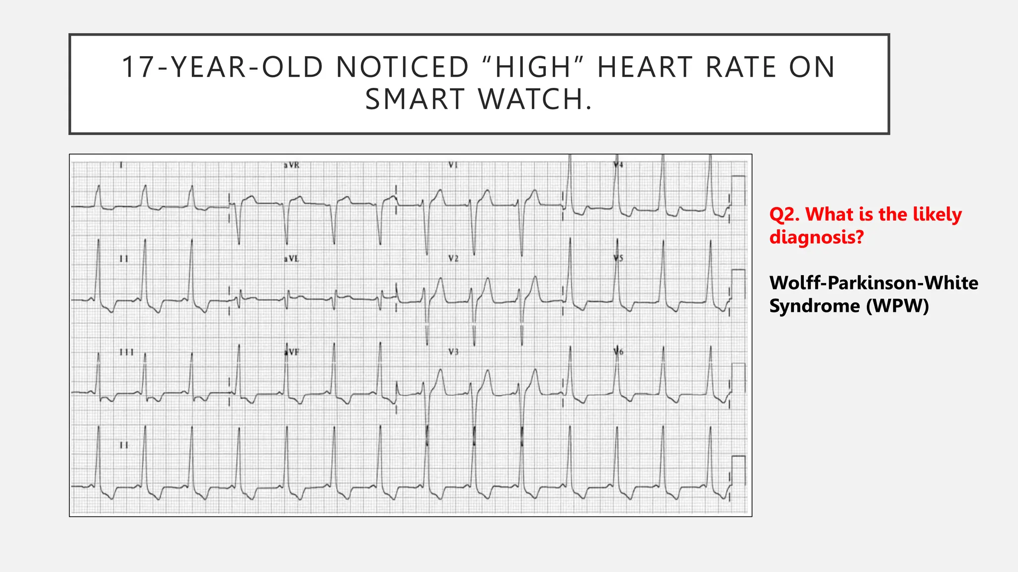 Lethal ECG pattern reading and diagnosis.pptx