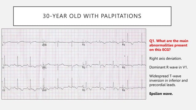 Lethal ECG pattern reading and diagnosis.pptx