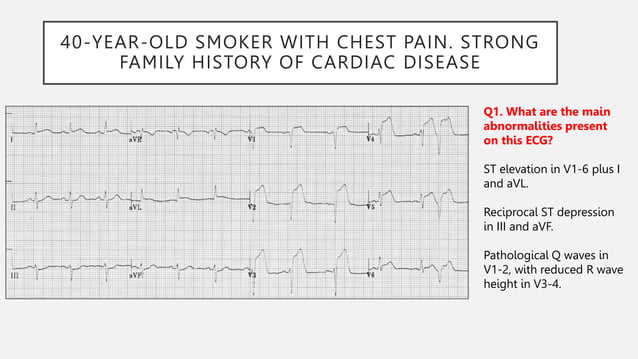 Lethal ECG pattern reading and diagnosis.pptx