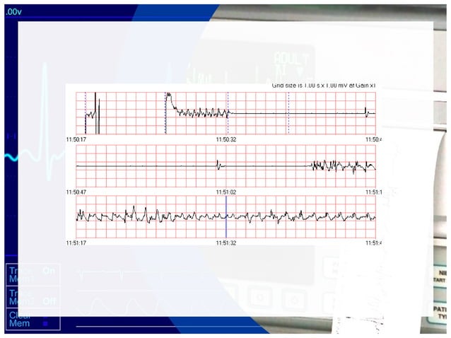 Lethal Cardiac Rhythms - Manual Defibrillation | PPT