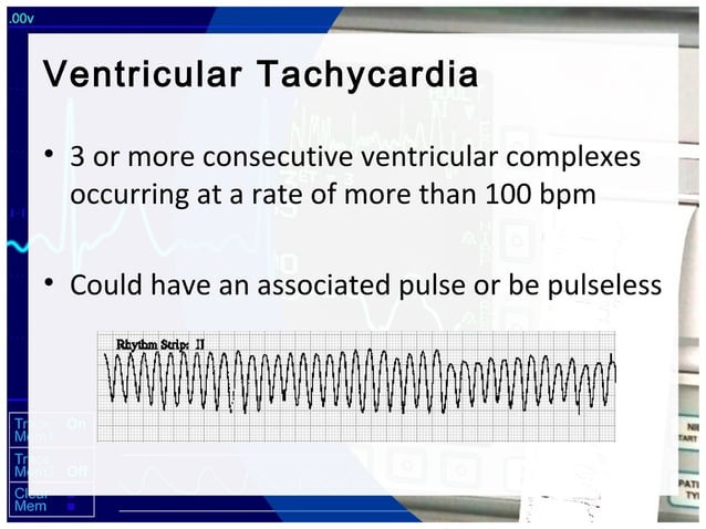 Lethal Cardiac Rhythms - Manual Defibrillation | PPT